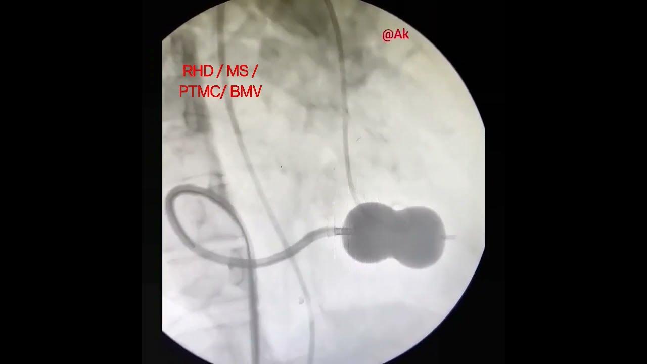 Reverse Loop Technique For Ptmc Bmv For Rhd Mitral Stenosis Youtube 0090