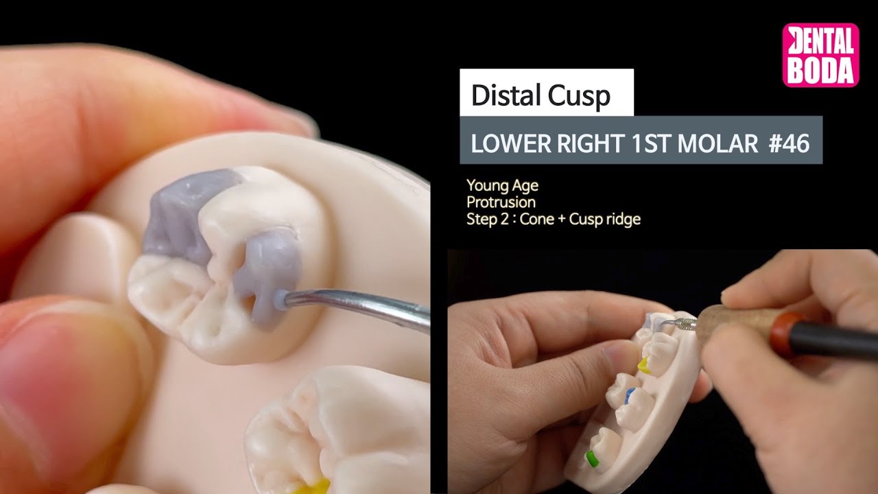 Lower Right 1st Molar distal cusp 2 cone+cusp ridge (young-aged) Wax-Up ...