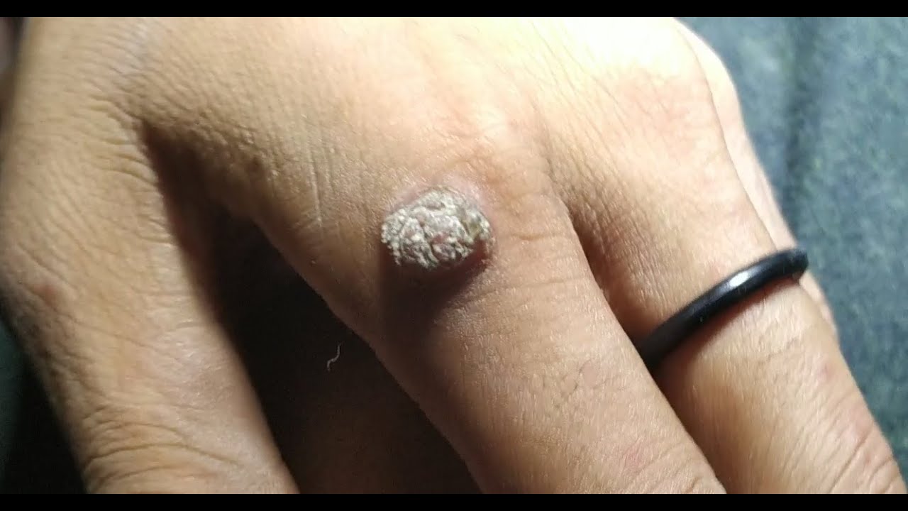 Wart Removal - YouTube