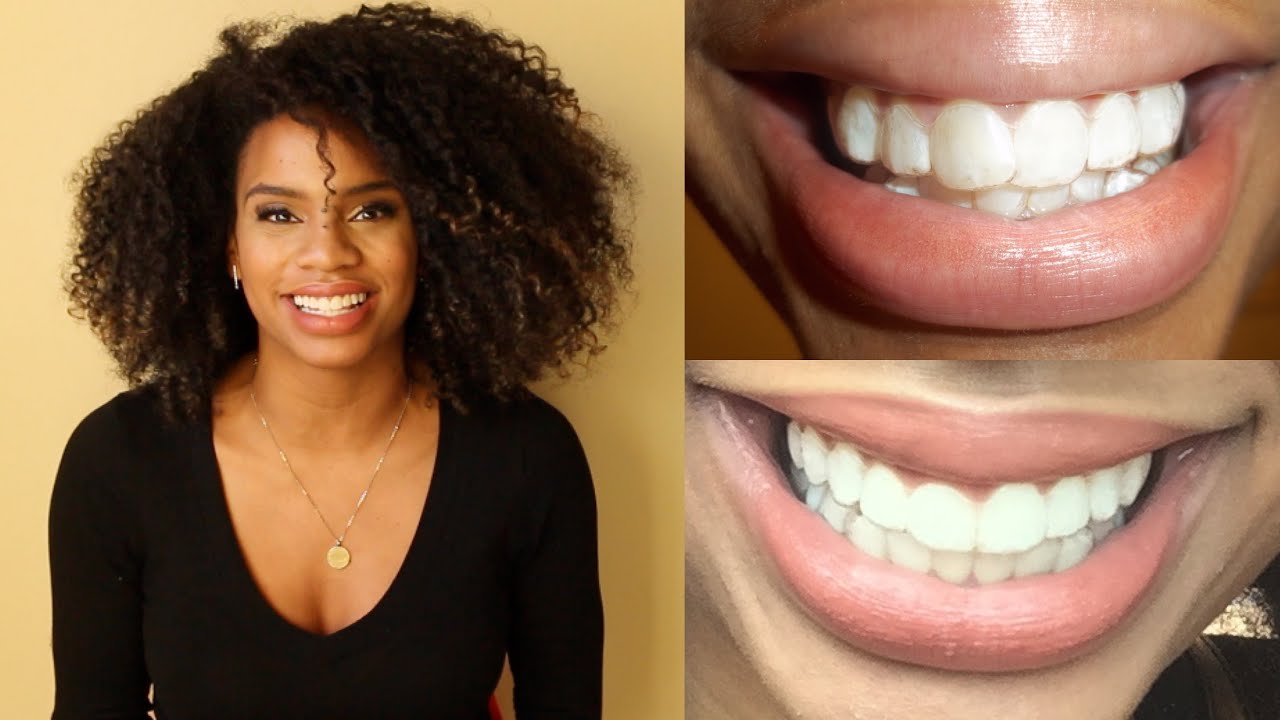 INVISALIGN UPDATE - 3 YEARS LATER - 126 TRAYS ASSIGNED - YouTube