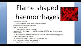 Flame Hemorrhage