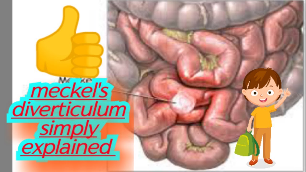 Meckel's diverticulum simply explained... - YouTube