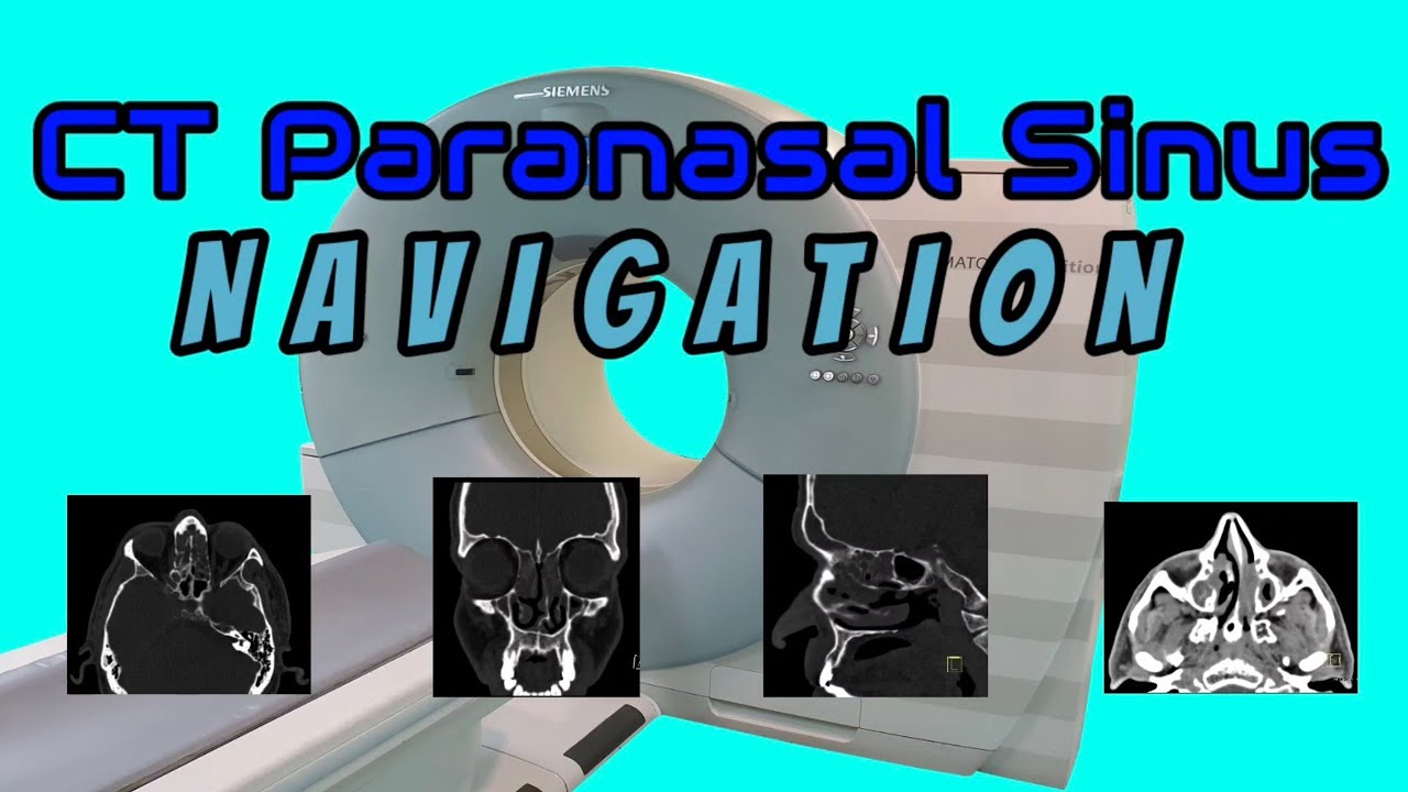 CT Paranasal Sinus Navigation - YouTube