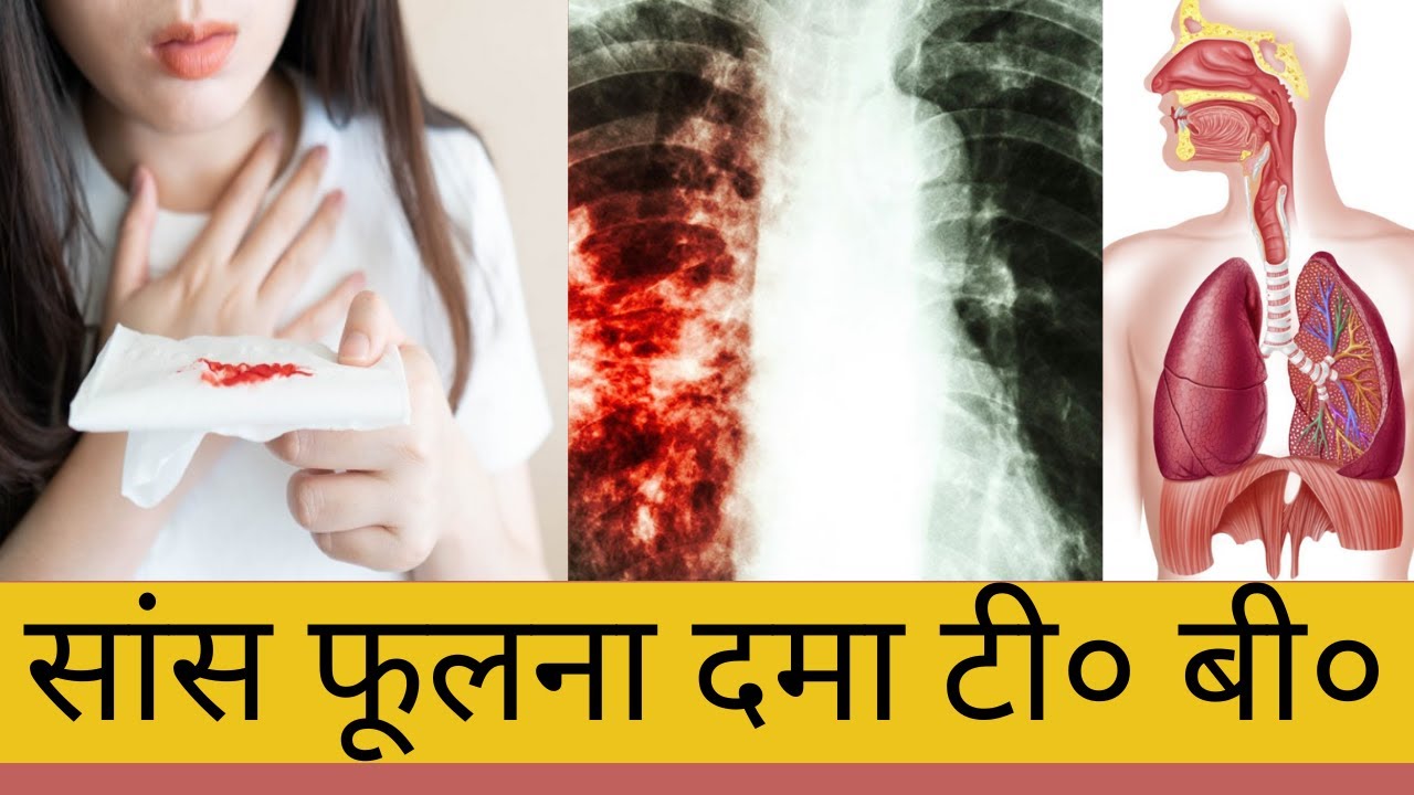 Tuberculosis: सांस लेने में दिक्कत,दमा respiratory problems Dr.Guru ...