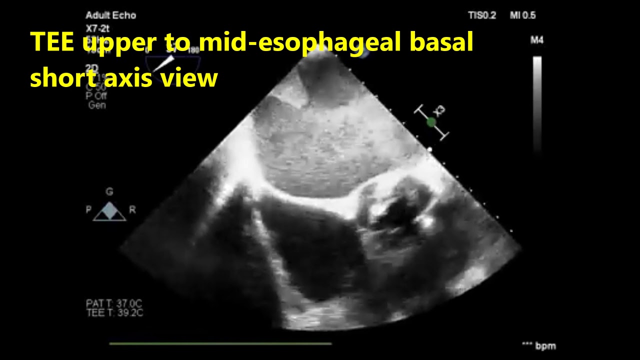 A transesophageal echocardiography (TEE) quiz - YouTube