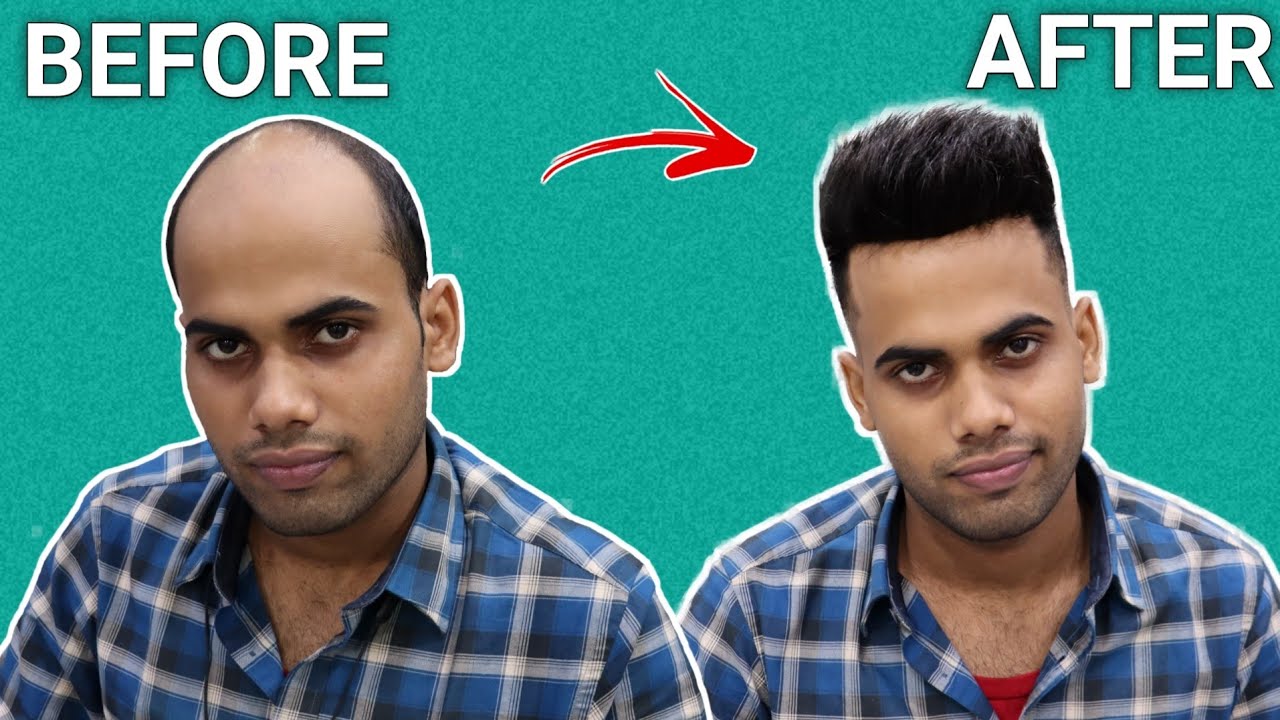 Hair Patch Transformation🔥 - YouTube