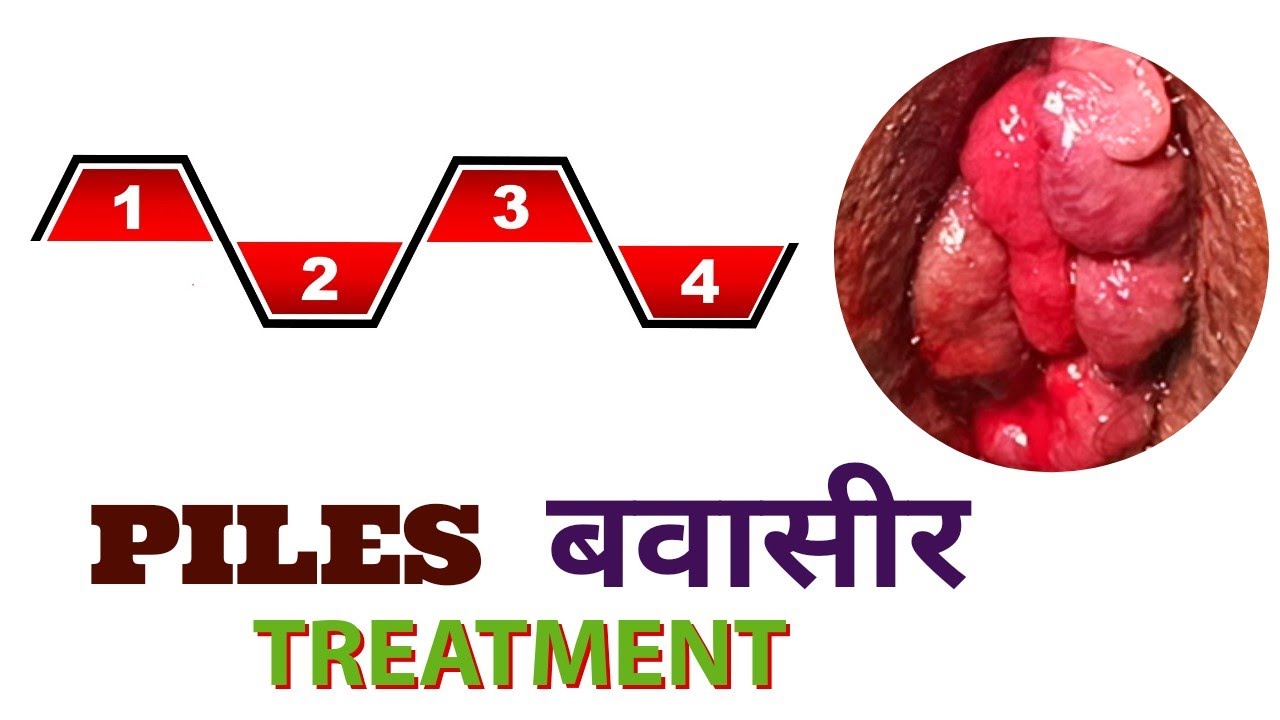 PILES - BAVASIR - GRADE 1,2,3,4 & TREATMENT - EASY TO UNDERSTAND - YouTube