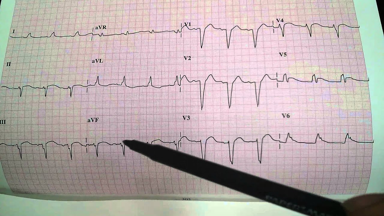 Severe Substernal Chest Pressure EKG Electrocardiogram ECG Dr. Uri Ben ...