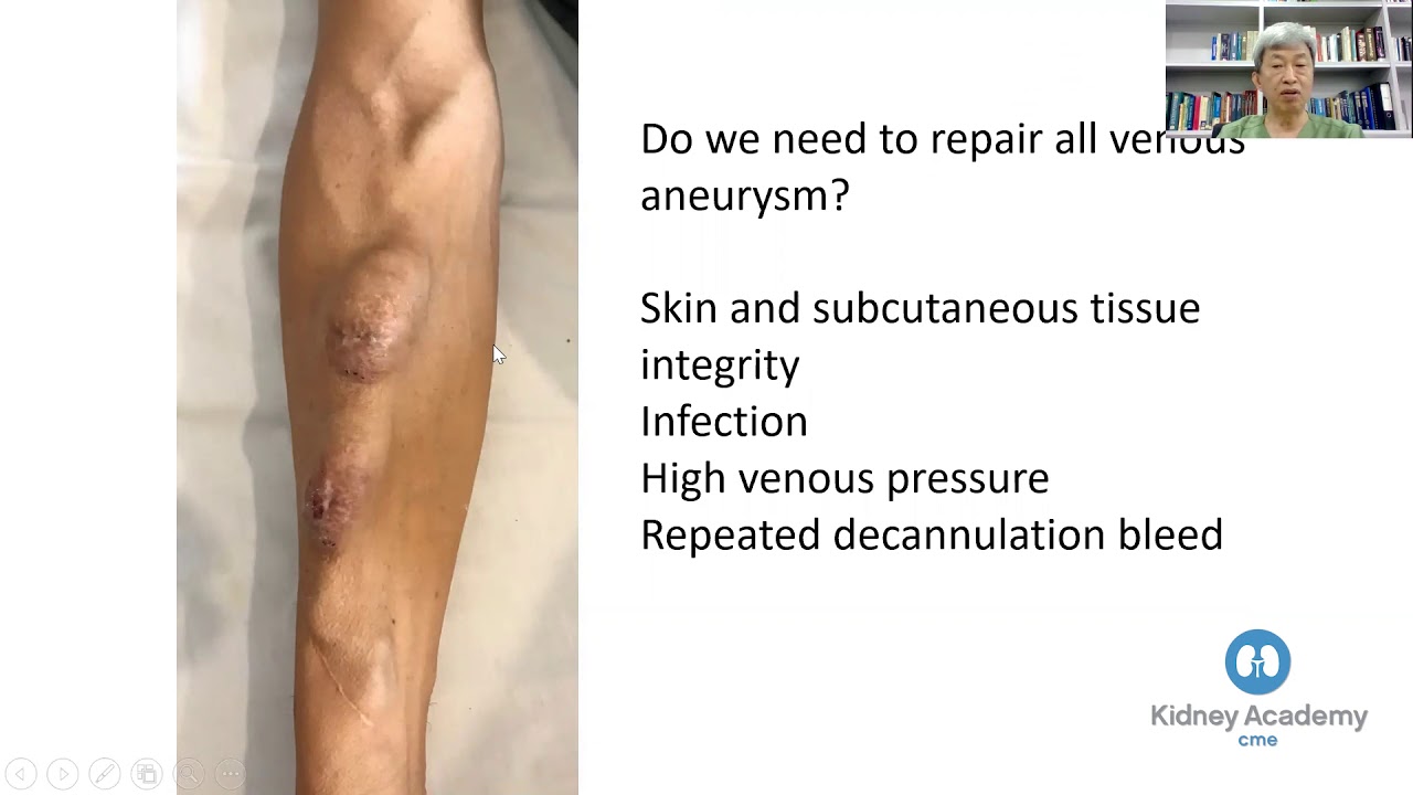 Managing life threatening bleed from an arteriovenous fistula - YouTube