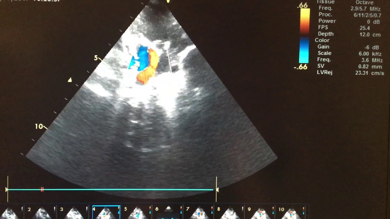 Complete Transposition of the Great Arteries (D-TGA) + PDA - YouTube