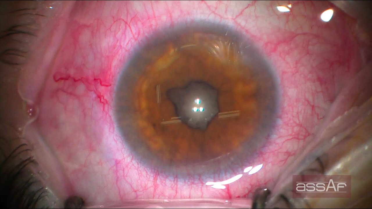 Should we use a mechanical pupil expander? - YouTube