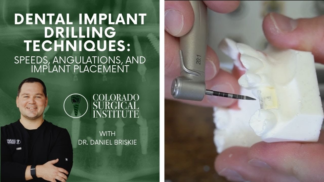 Dental Implant Drilling Techniques: Speeds, Angulations, and Implant ...