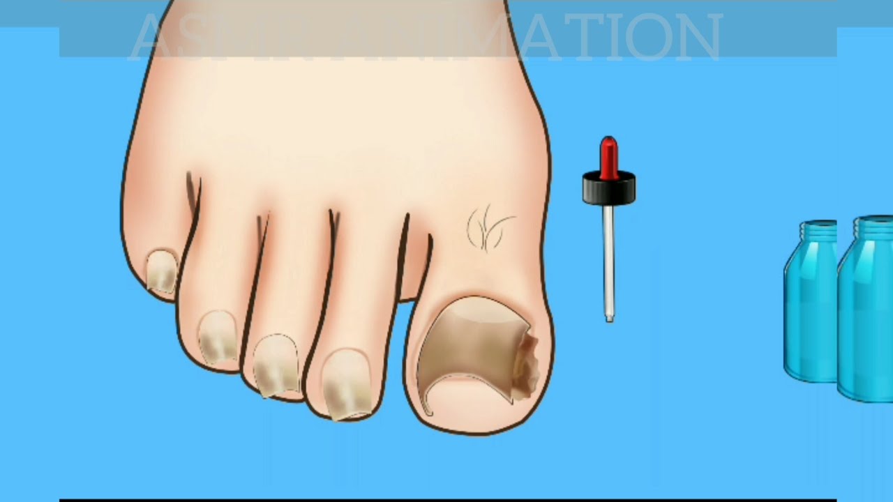 ASMR coolness | ingrown toenails cleaning treatment animation - YouTube