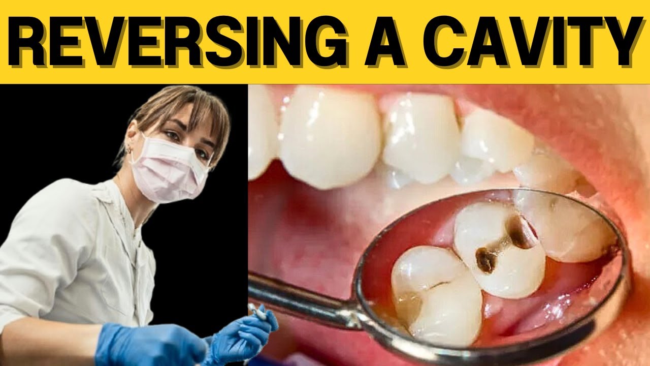 How to Naturally Reverse Cavities at Home | Heal Tooth Decay - YouTube