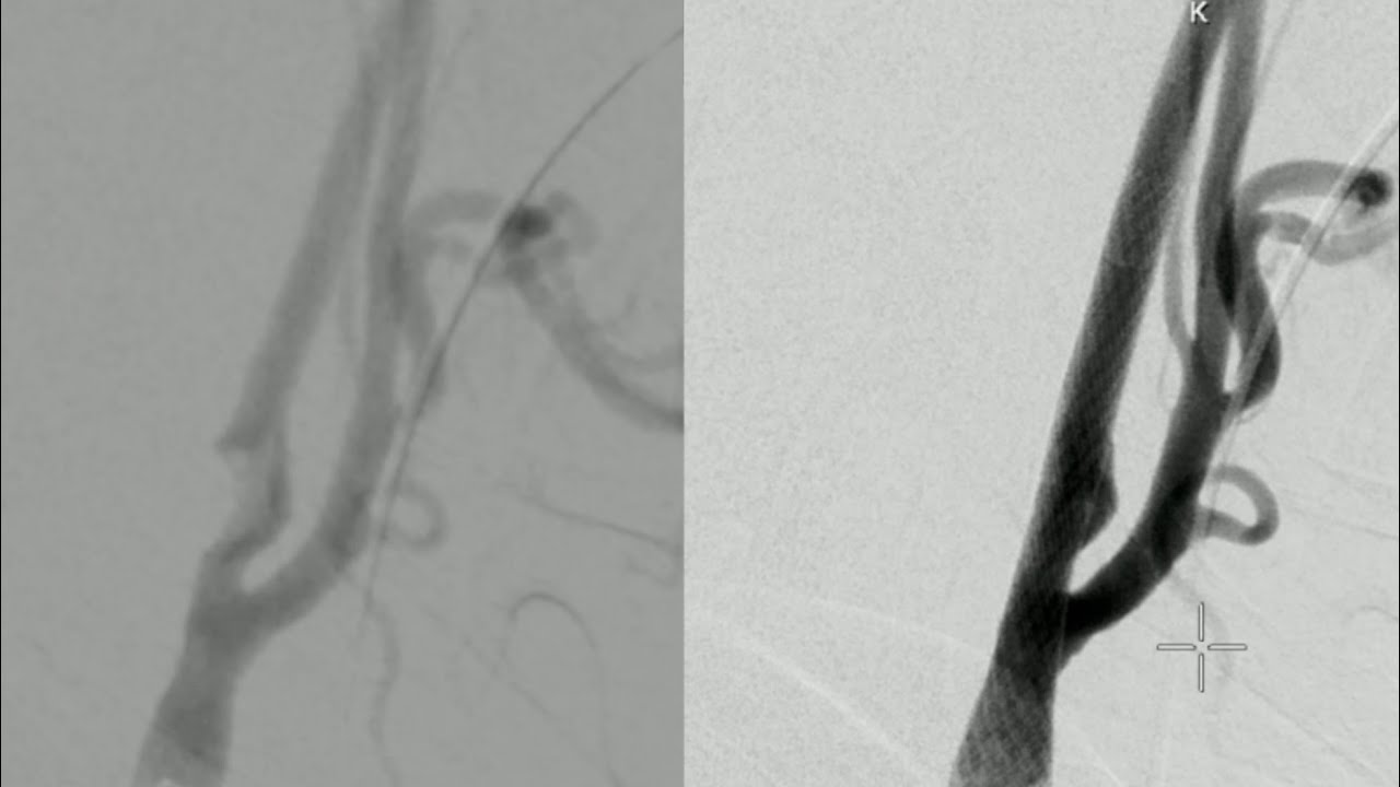 (English) Floating thrombus in the ICA. Stent implantation - YouTube