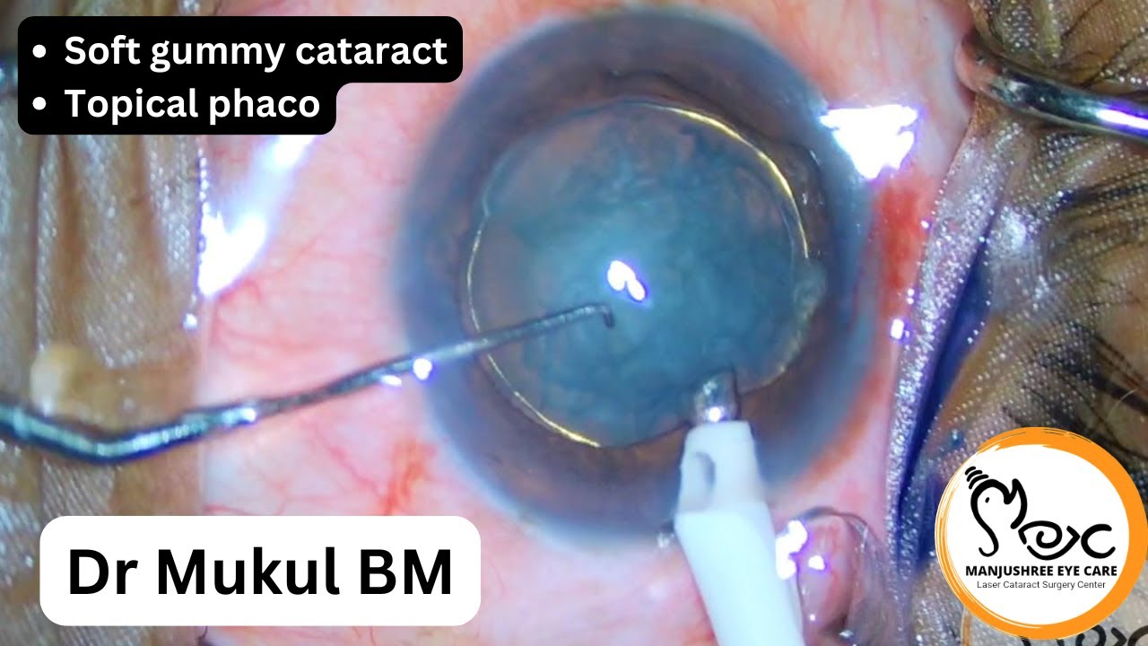 gummy cataract - Topical phaco - YouTube