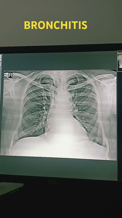 XRAY CHEST PA (BVM) BOTH LUNG FEALD - YouTube