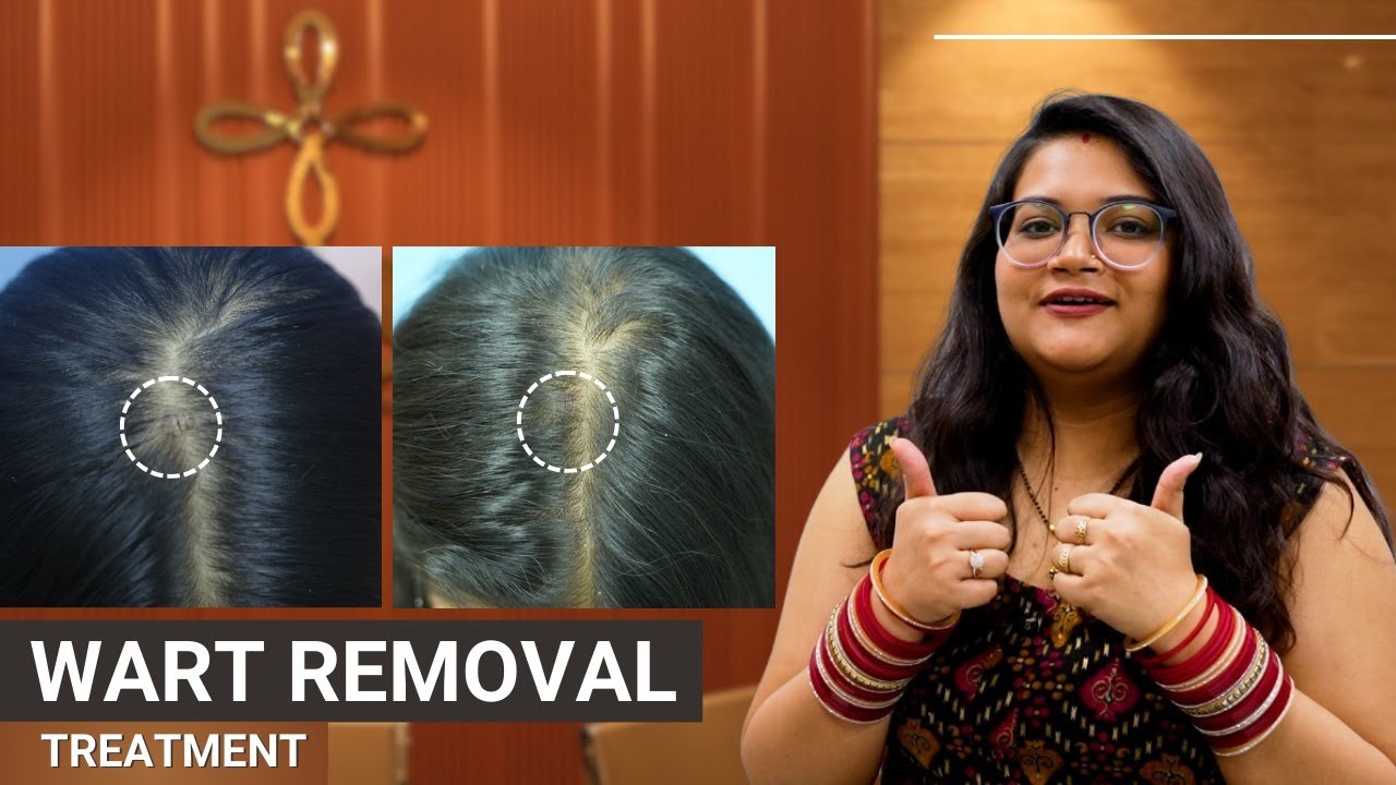 Wart Removal Wart Removal Laser Treatment Wart Removal Result By