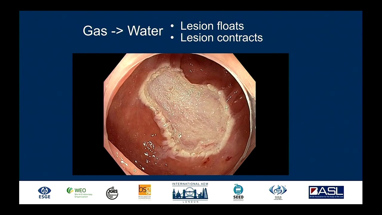 Underwater EMR (UEMR) in the colon - YouTube