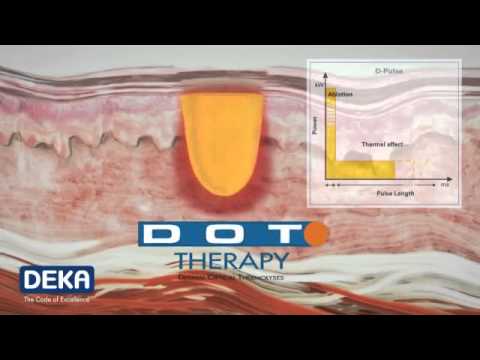 MonaLisa Touch treatment by SmartXide2 (V2LR).wmv.mp4 - YouTube