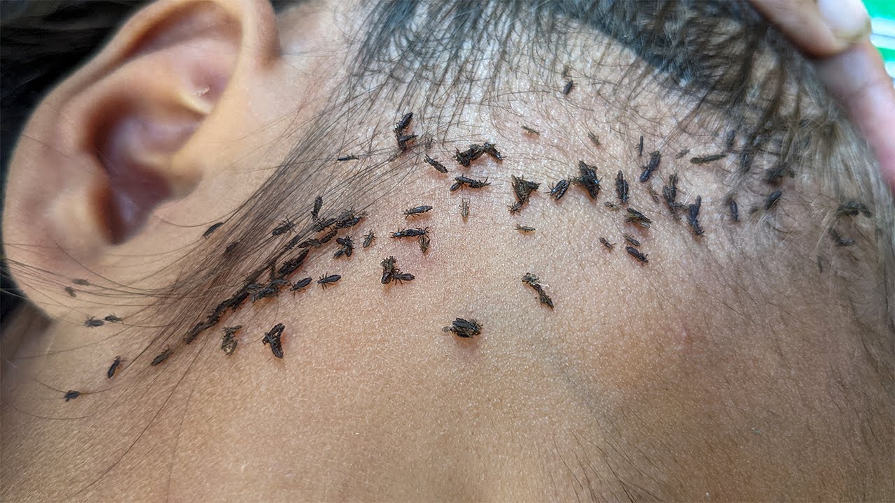 Wow there are a lot of head lice - Remove hundred lice from short hair ...