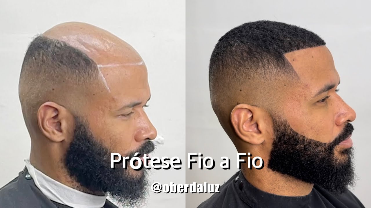 Prótese Capilar Masculina Fio a fio / a melhor transformação que você ...