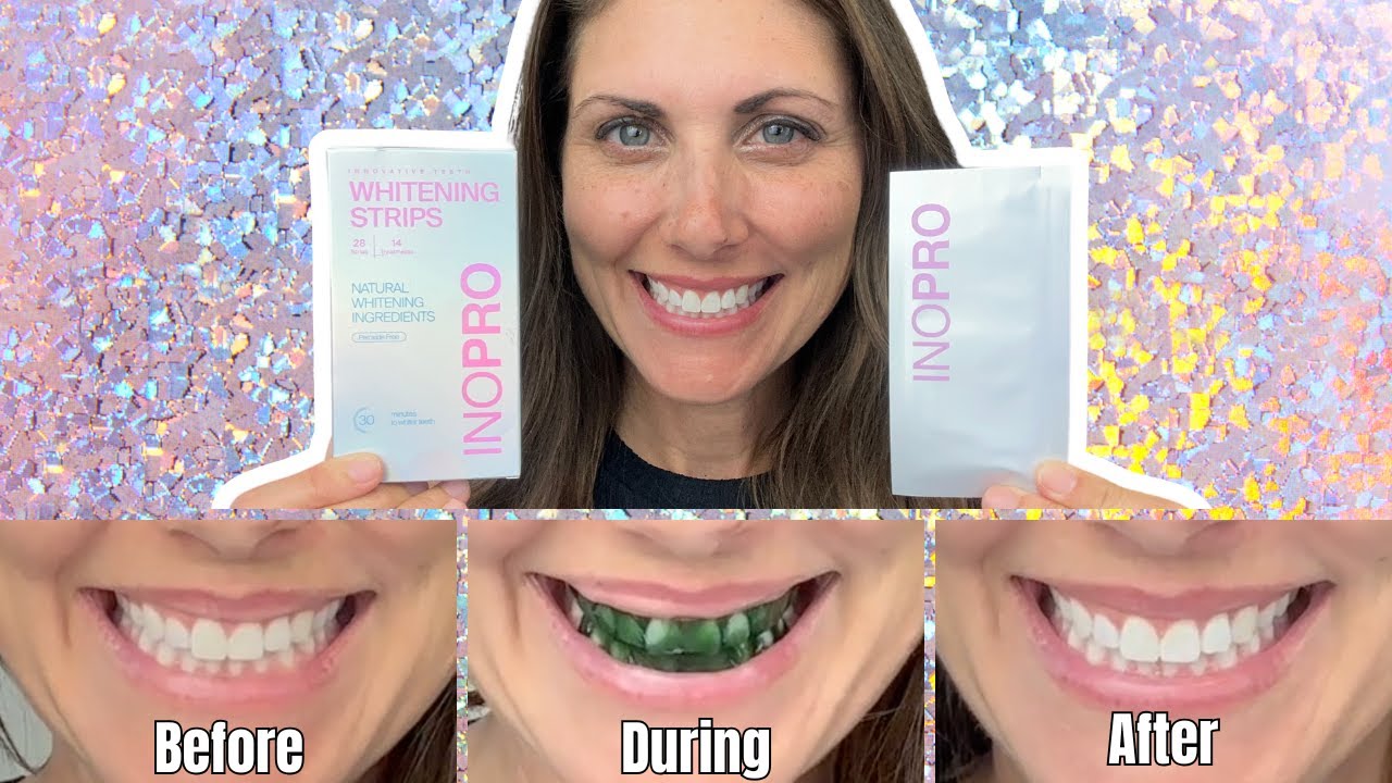WOW! INOPRO Teeth Whitening Strips Results After Just 1 Use & Tutorial ...