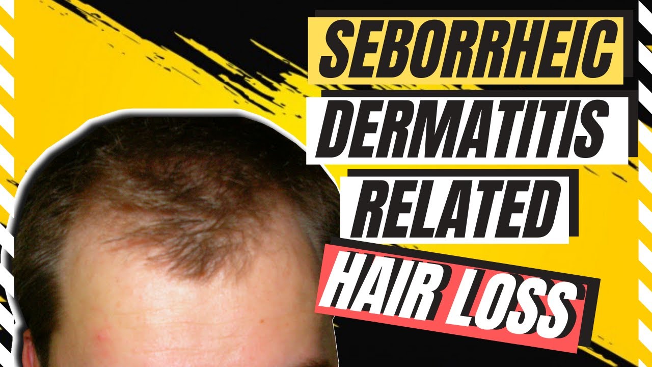 Scalp Seborrheic Dermatitis, What It Is, Symptoms and Treatment - YouTube