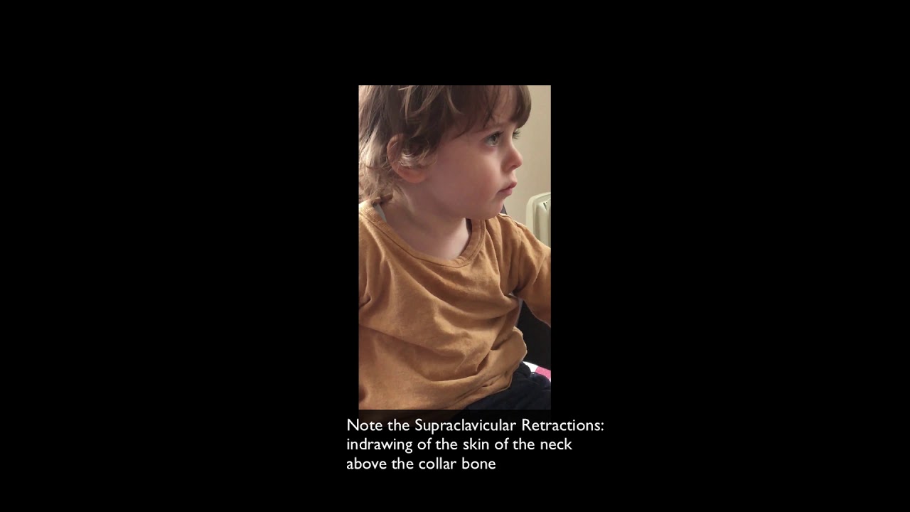 Supraclavicular retractions - YouTube