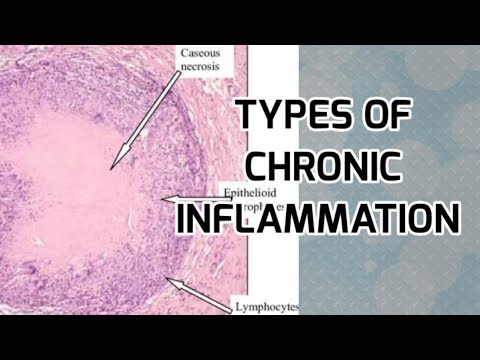 Types of chronic inflammation - YouTube