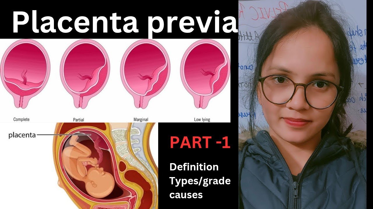 Placenta previa, definition, types, causes # ...