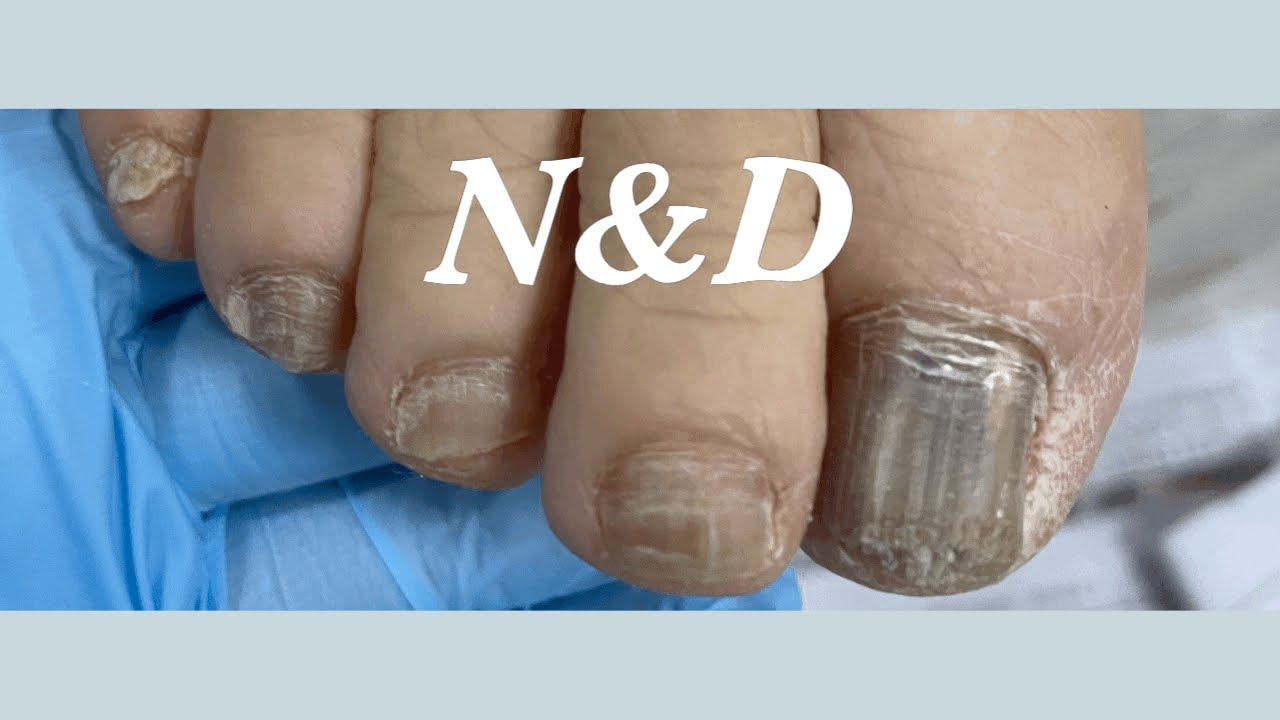 nail /toenail /nailcare /athlete’s foot /practice /nail&drill - YouTube