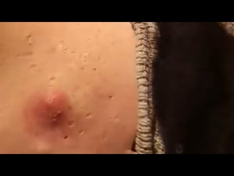 Gross but satisfying real life EXPLODING Spot/Pimple/Cyst 3 massive ...