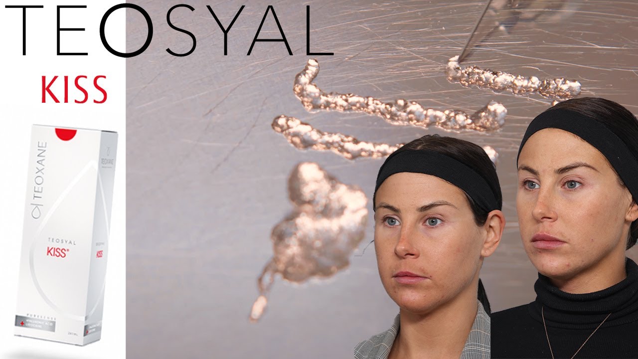 Lip Filler Teosyal Kiss With Before And After Pictures - YouTube