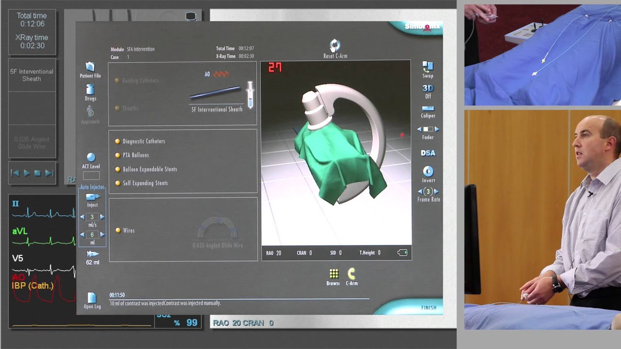 Superficial Femoral Artery (SFA) Angioplasty - YouTube