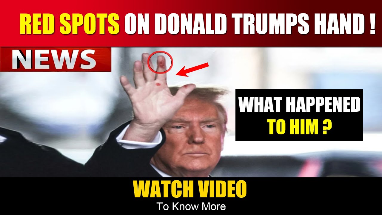 Red Spots Spotted On Donald Trumps Hand | What happened to him ? donald ...