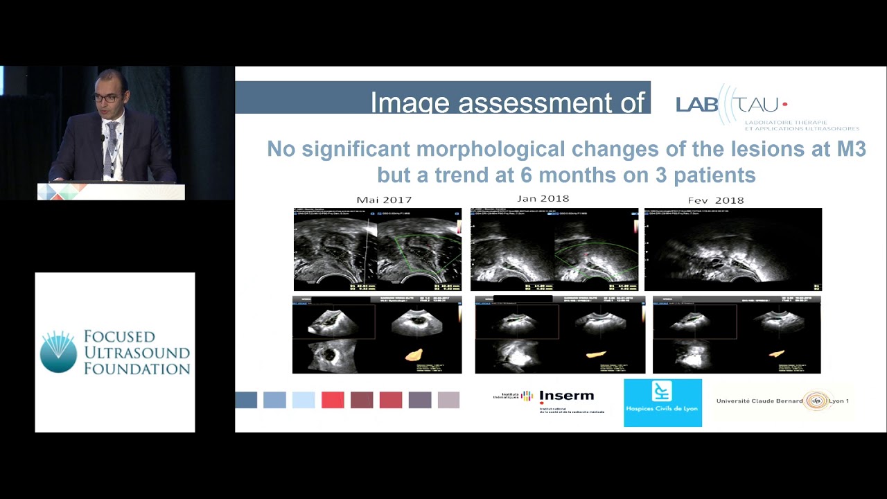 Gil Dubernard - Transrectal HIFU as focal therapy for rectal ...