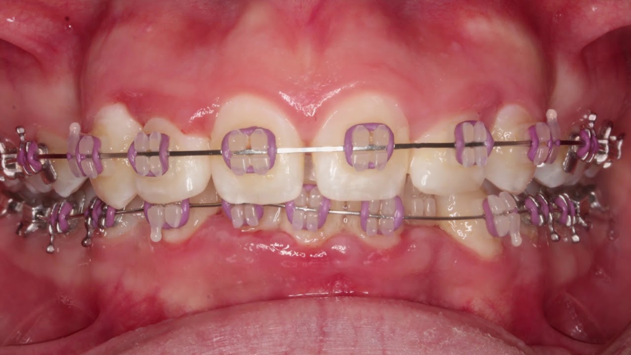 Light Purple Braces