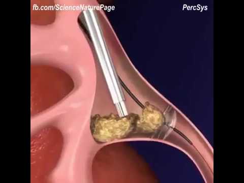Retrait d'un caillot dans les Reins ! animation 3D - YouTube