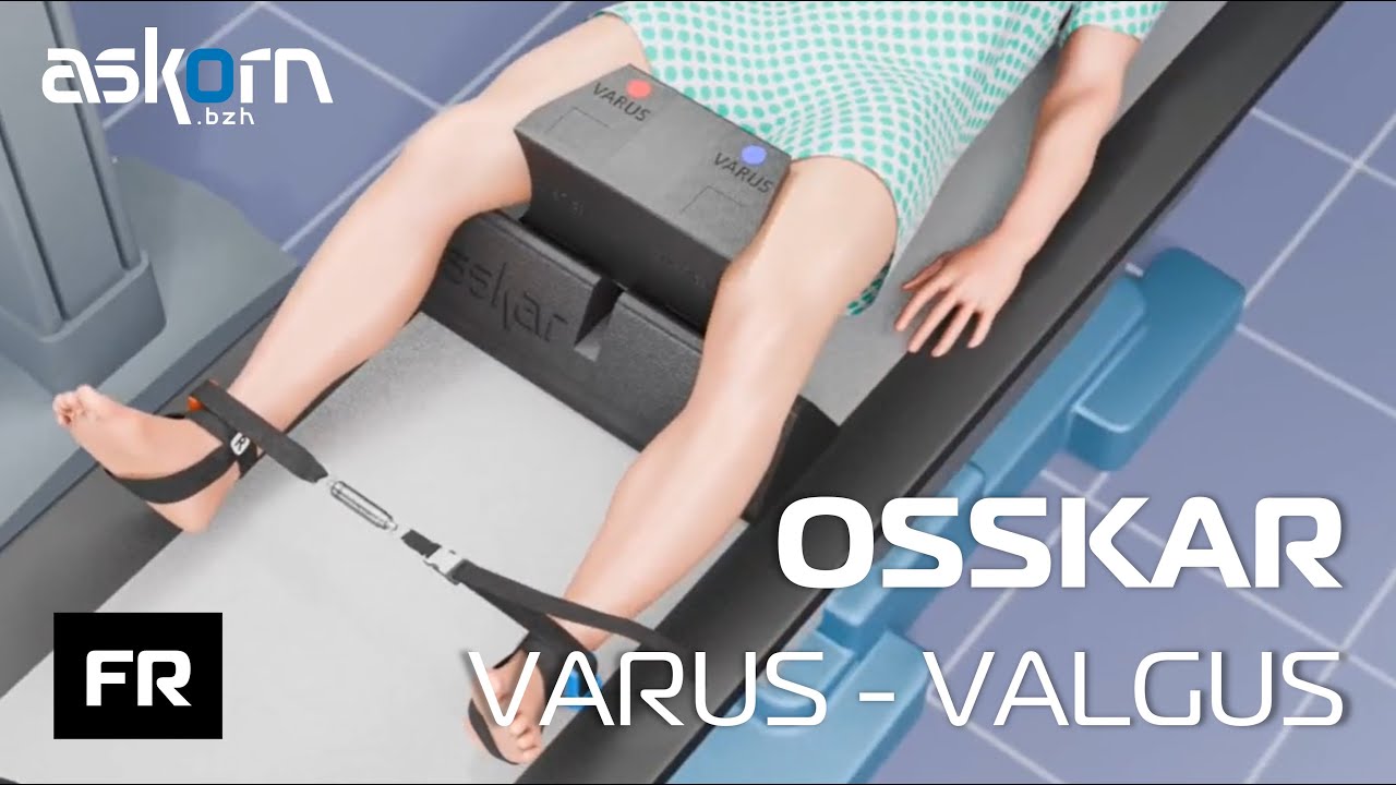 [FR] OSSKAR Varus Valgus | Dispositif de positionnement pour ...