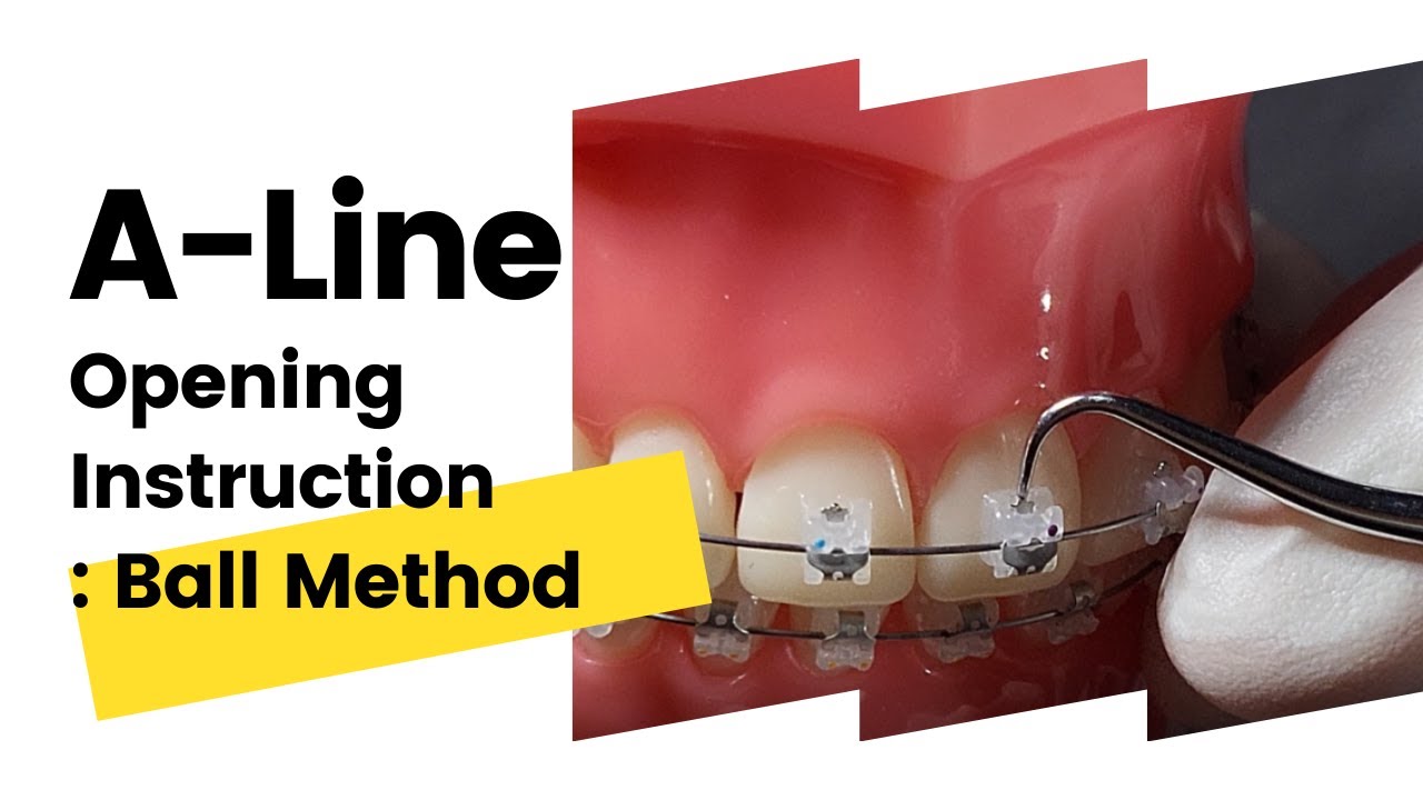 A-Line opening instruction : Ball Method - YouTube