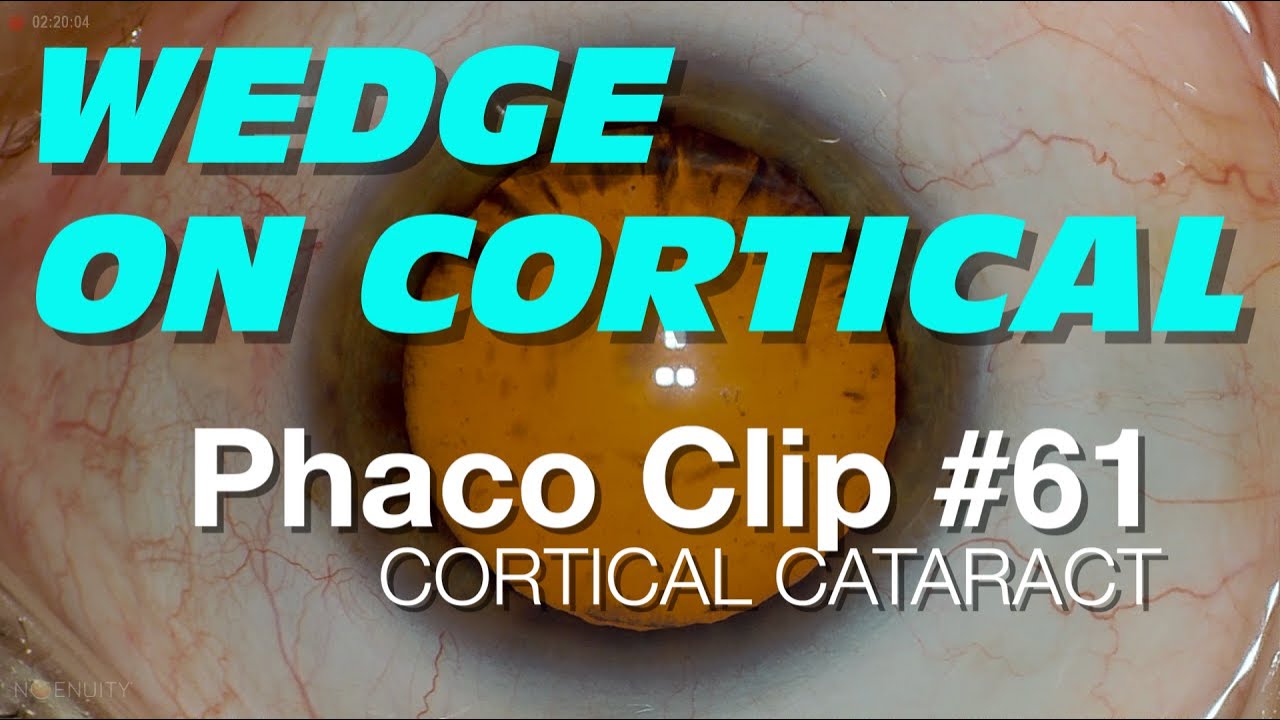 Phaco Clip #61 - Cortical Cataract - YouTube