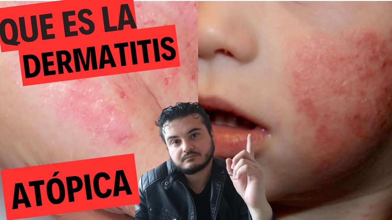 Costras en la cara de tu bebé o resequedad en rodillas y codos? ES ...