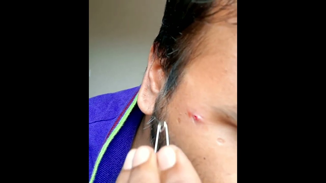 Relaxing spa pimple popping videos - Removing pimples from face asmr ...