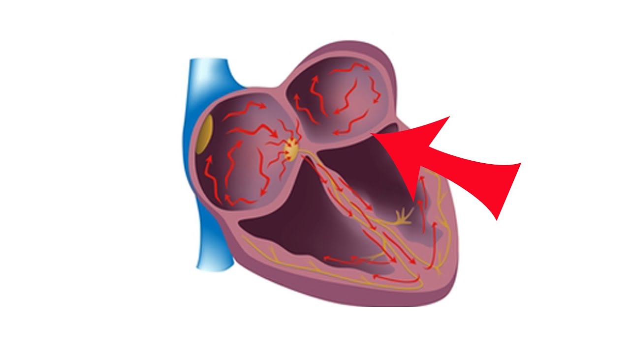 Should Atrial Fibrillation Be Treated During Mitral Tricuspid Valve should-atrial-fibrillation-be-treated-during-mitral-tricuspid-valve