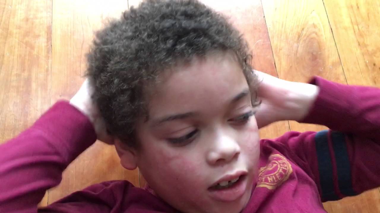 Cold Urticaria - Hives from the cold air or weather - YouTube