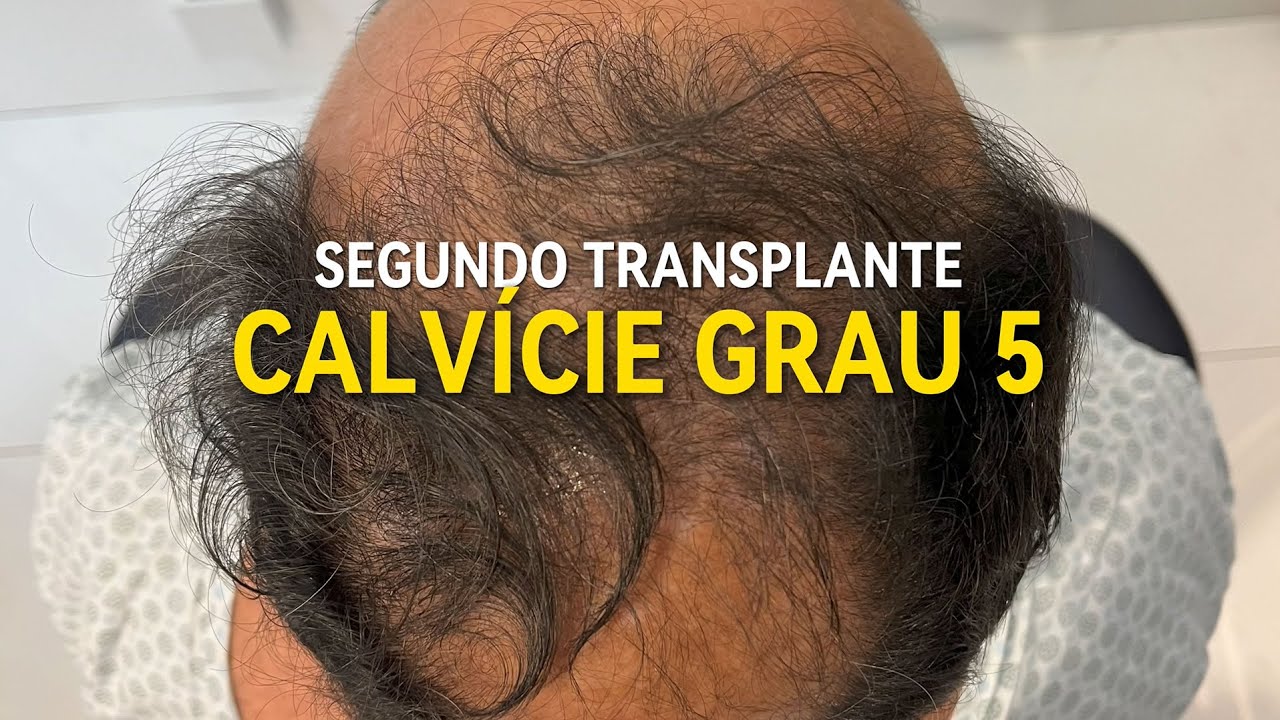 CALVÍCIE GRAU 5 - 2º TRANSPLANTE CAPILAR - YouTube