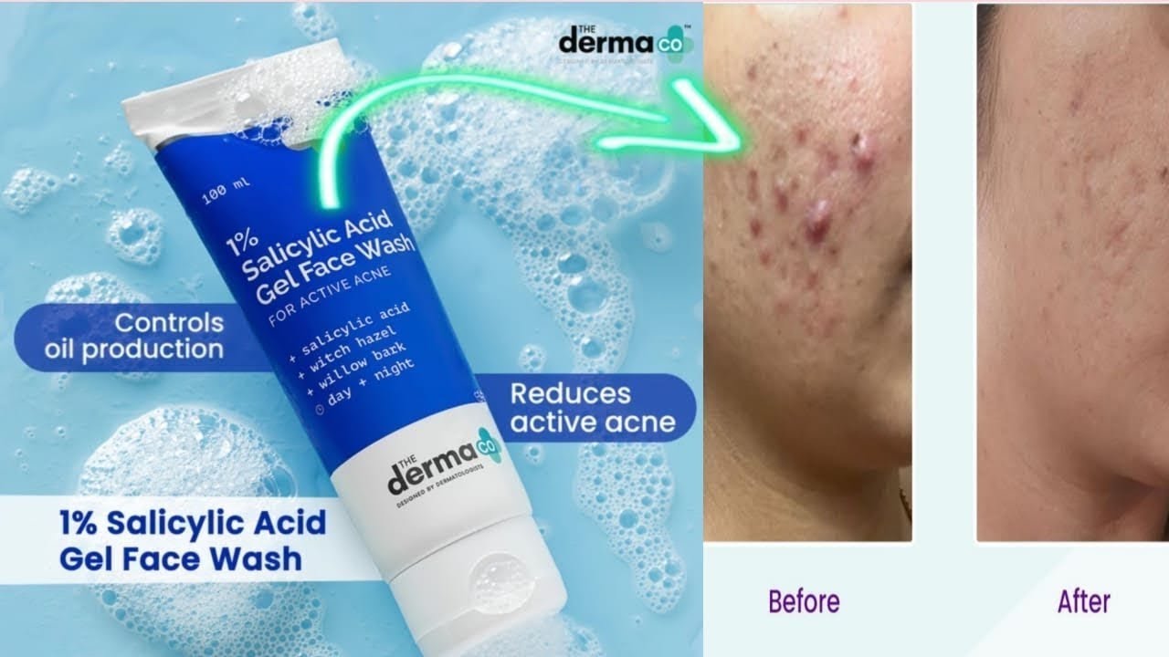1% salicylic acid gel face wash for active acne - YouTube