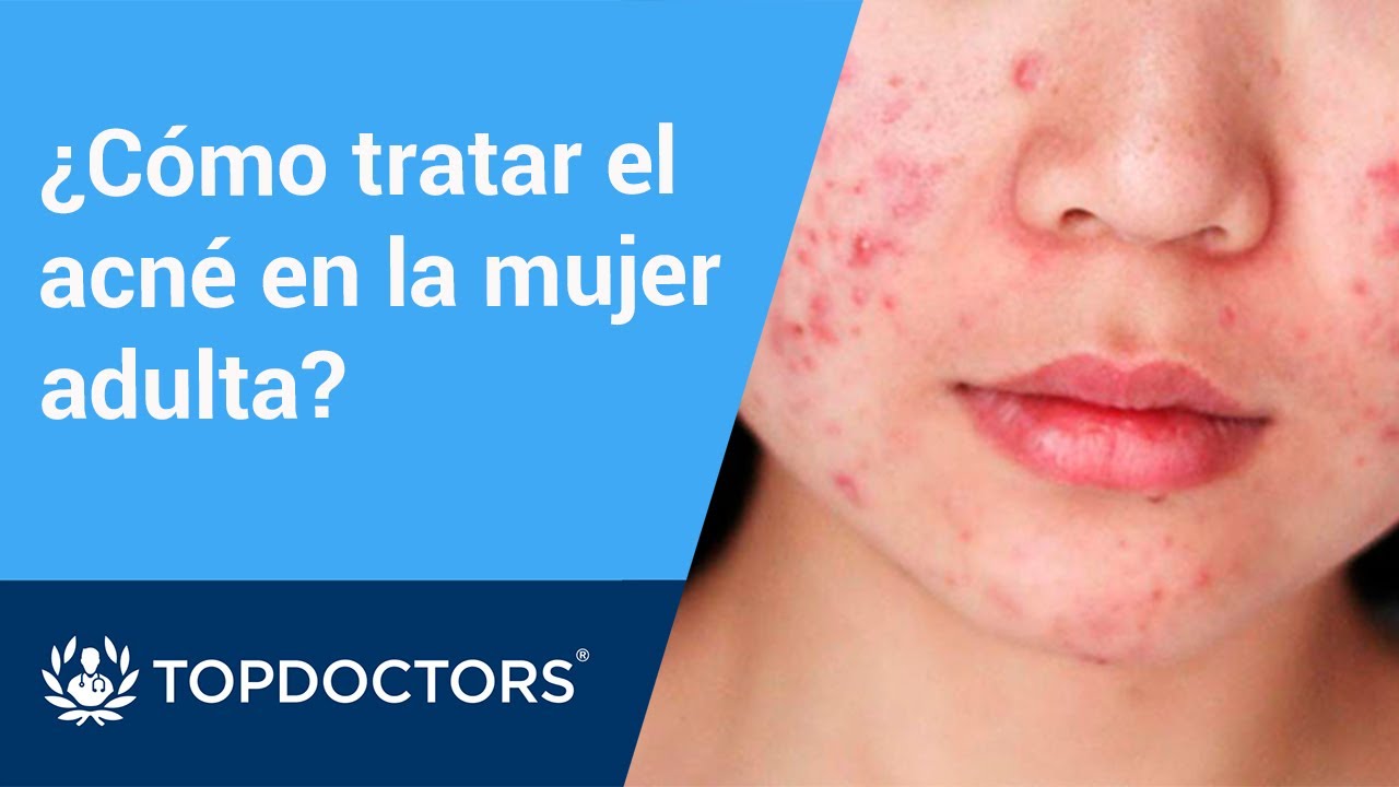 ¿Cómo tratar el acné en la mujer adulta? - Dr. Pablo de la Cueva (3/4 ...