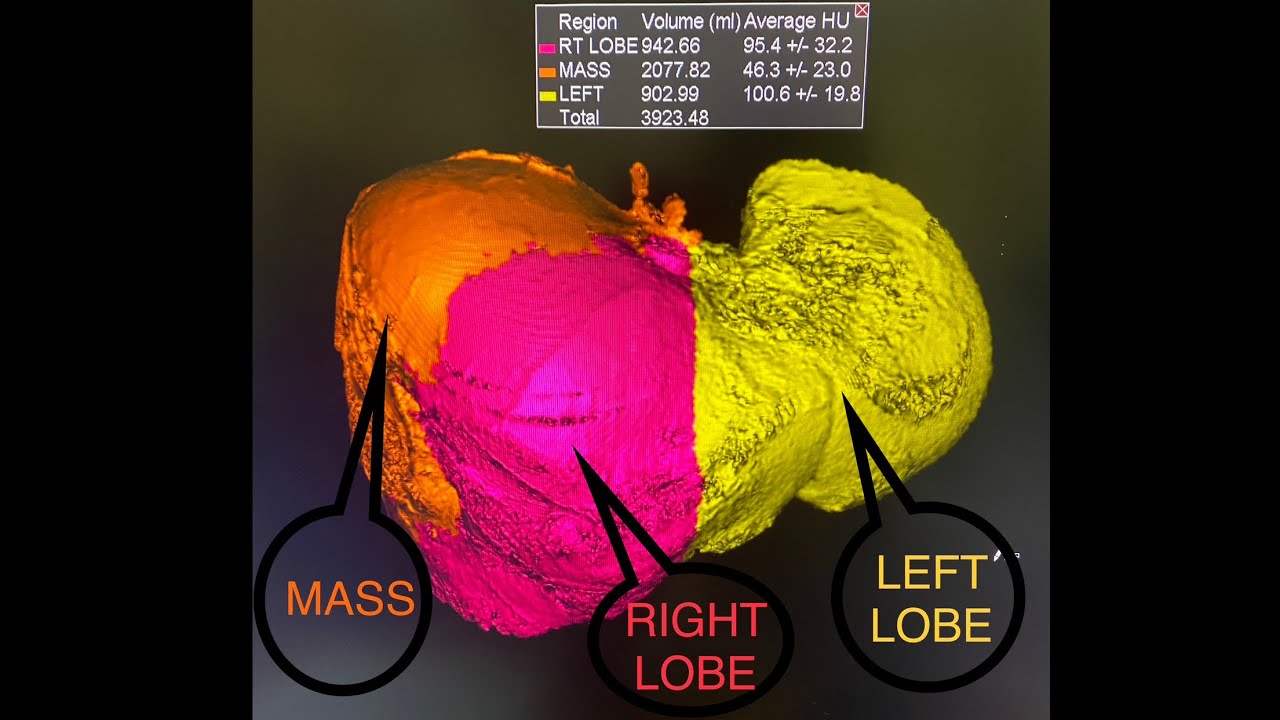 CT Volumetry liver(Patient HCC with Large hepatic focal lesion) Used ...